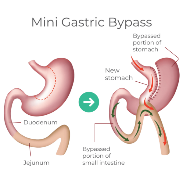 Bariatric Surgery - MedEx