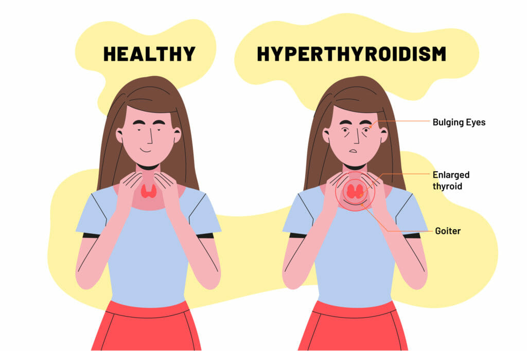 Thyroidectomy - MedEx